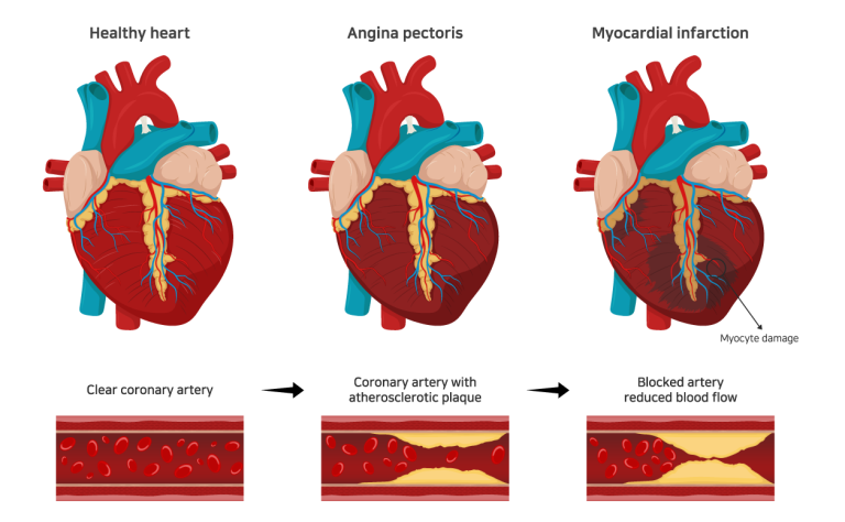 Heart Disease – Virginia Department of Health – VDHLiveWell